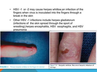 viral infections of the oral cavity | PPTX