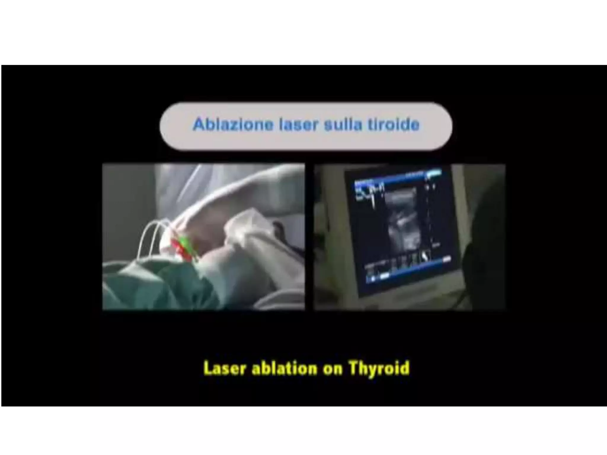 laser ablation vs radioiodine in toxic nodular goiters jcem | PPTX ...