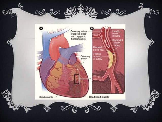 heart attack | PPT
