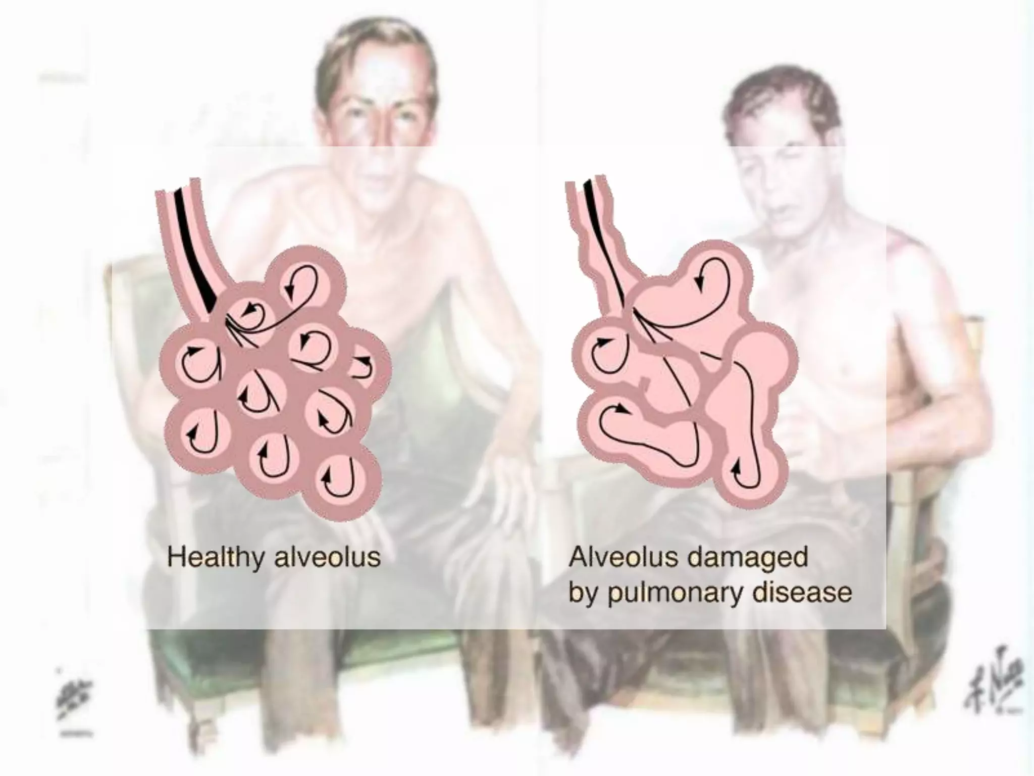aetiology and pathogenesis of chronic obstructive lung disease | PPTX
