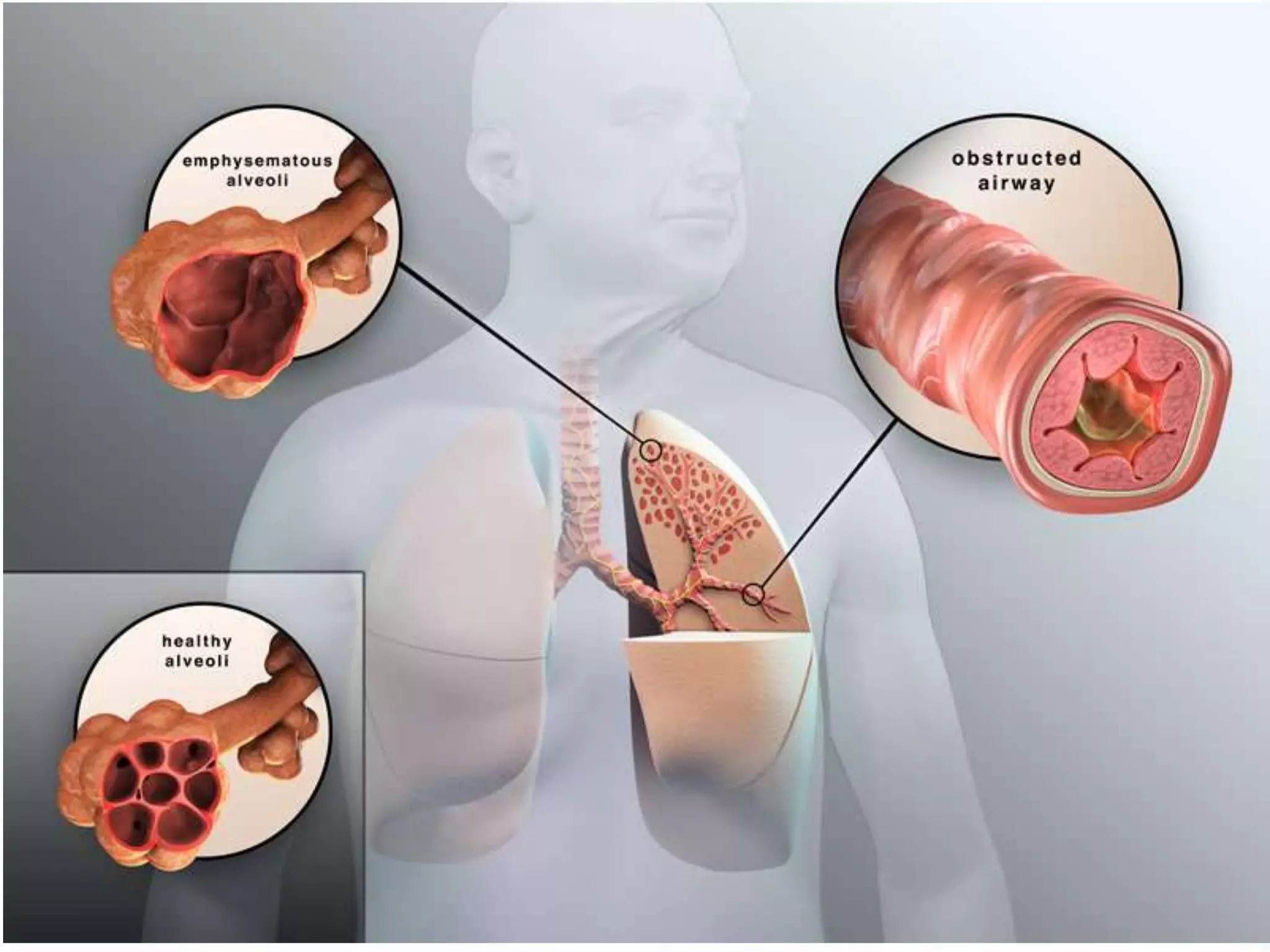 aetiology and pathogenesis of chronic obstructive lung disease | PPT