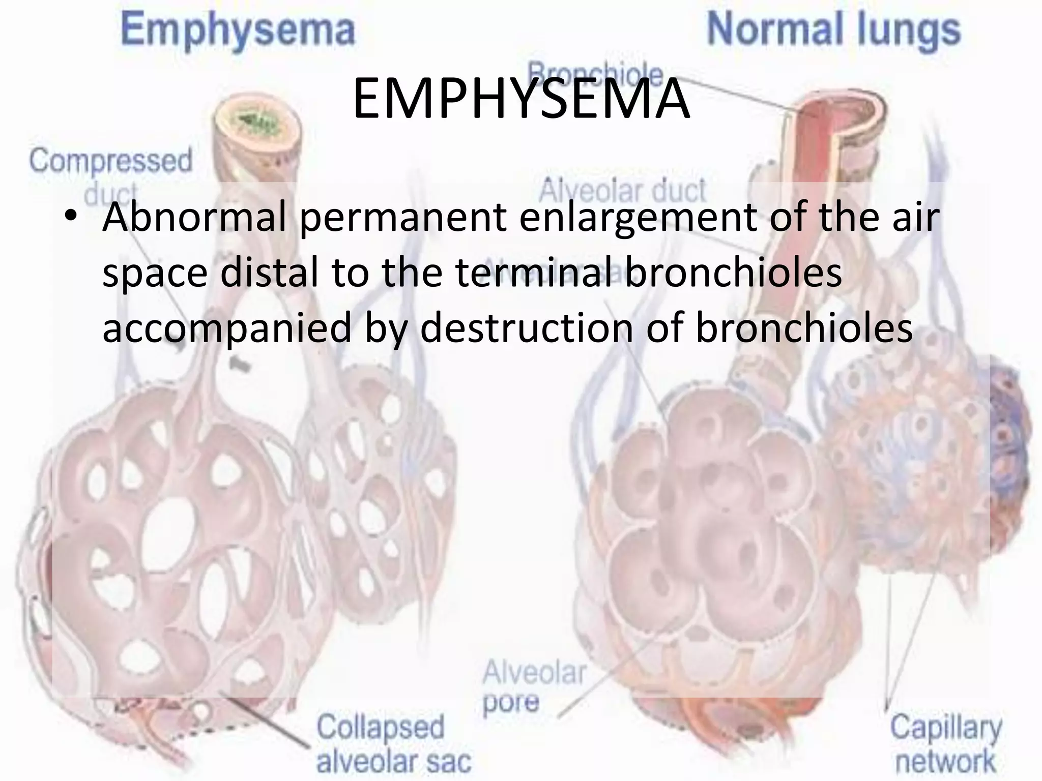 aetiology and pathogenesis of chronic obstructive lung disease | PPTX