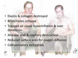 aetiology and pathogenesis of chronic obstructive lung disease | PPTX