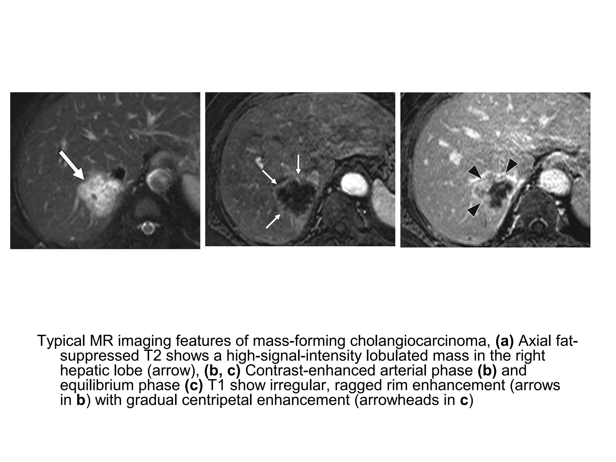 Diagnostic Imaging of Cholangiocarcinoma | PPT