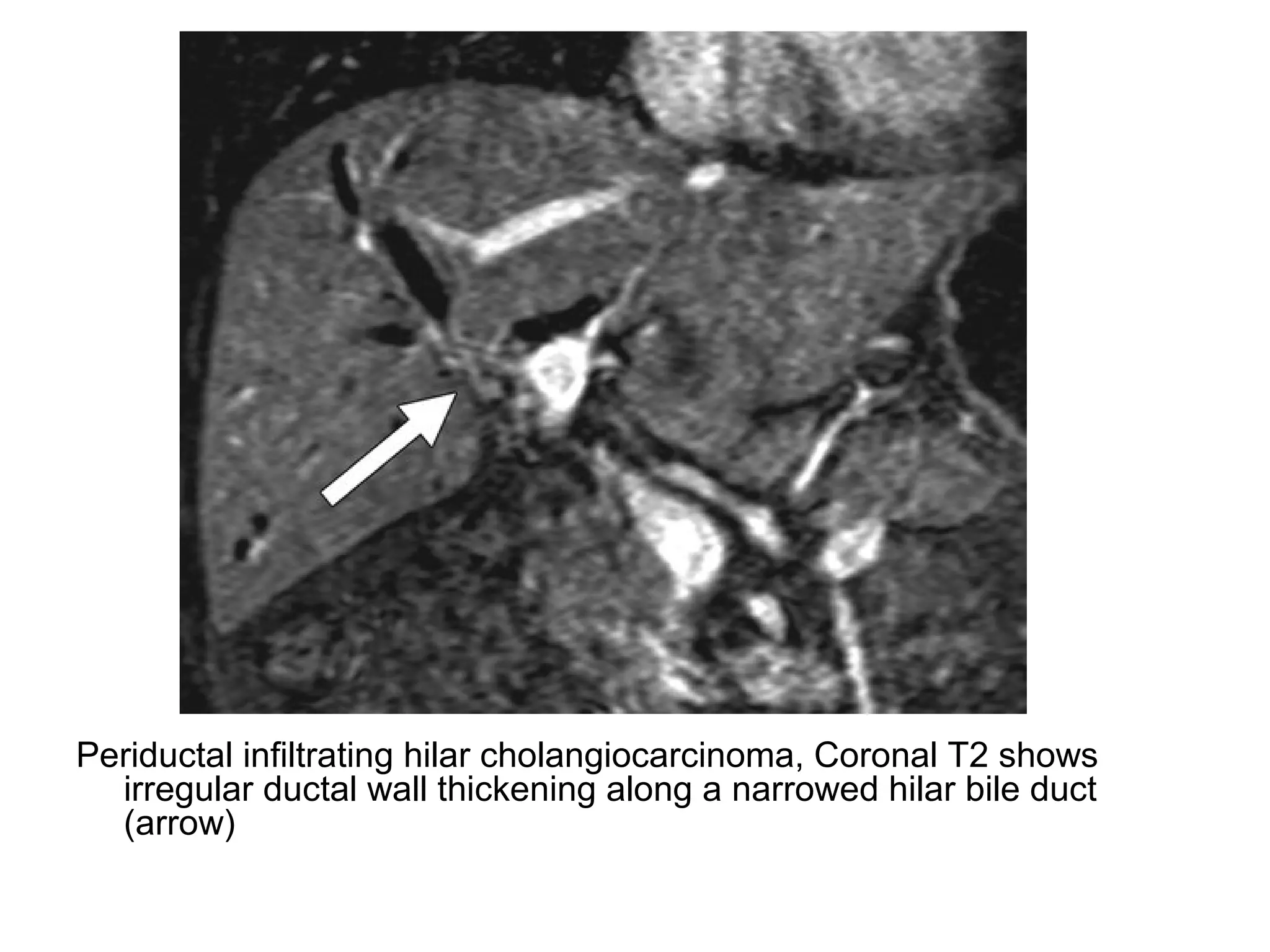 Diagnostic Imaging of Cholangiocarcinoma | PPT