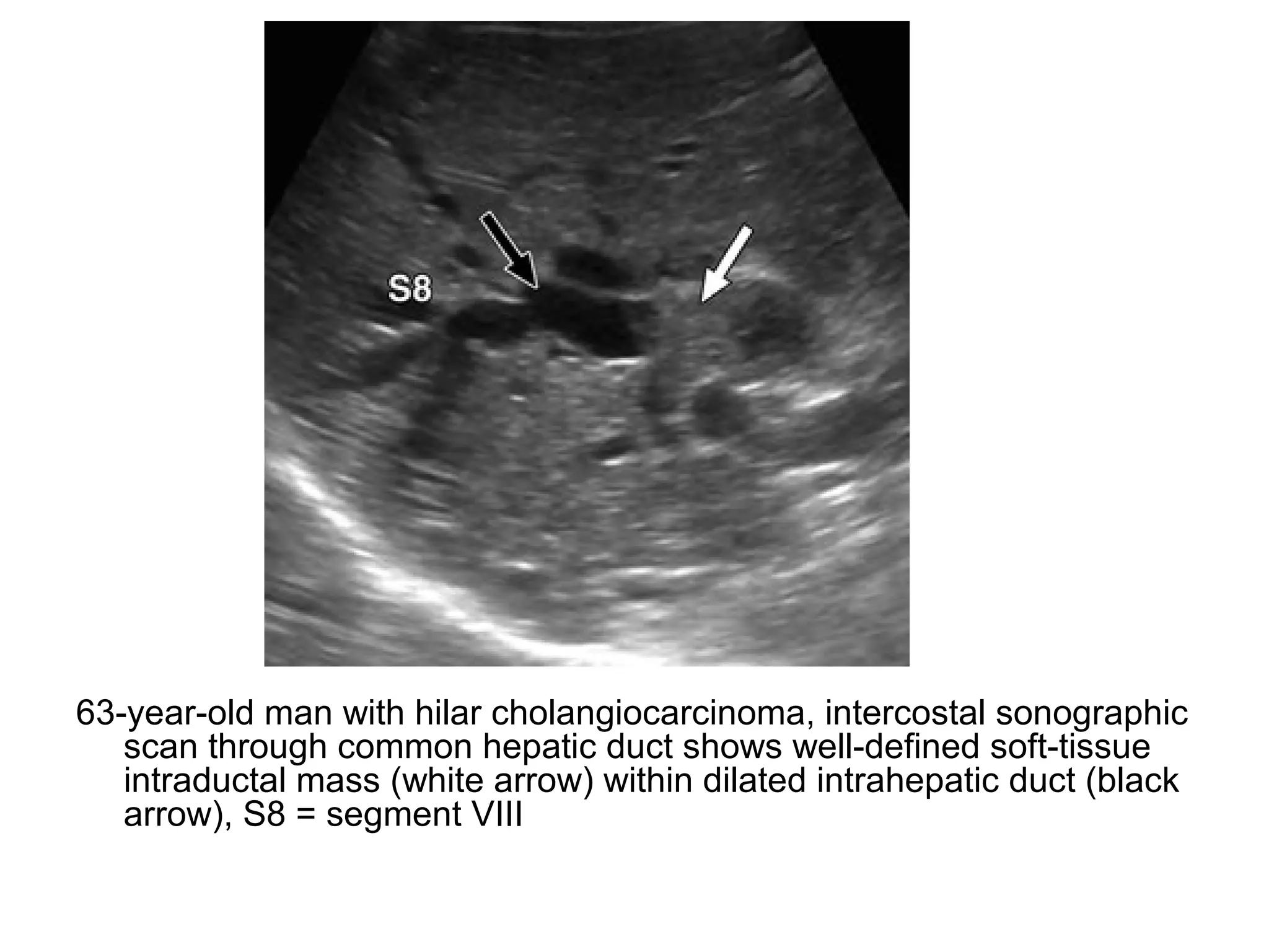 Diagnostic Imaging of Cholangiocarcinoma | PPT