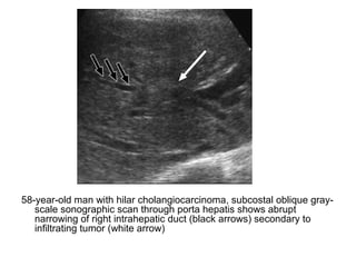 Klatskin Tumor Ultrasound