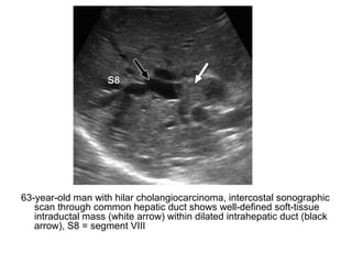 Cholangiocarcinoma Ultrasound