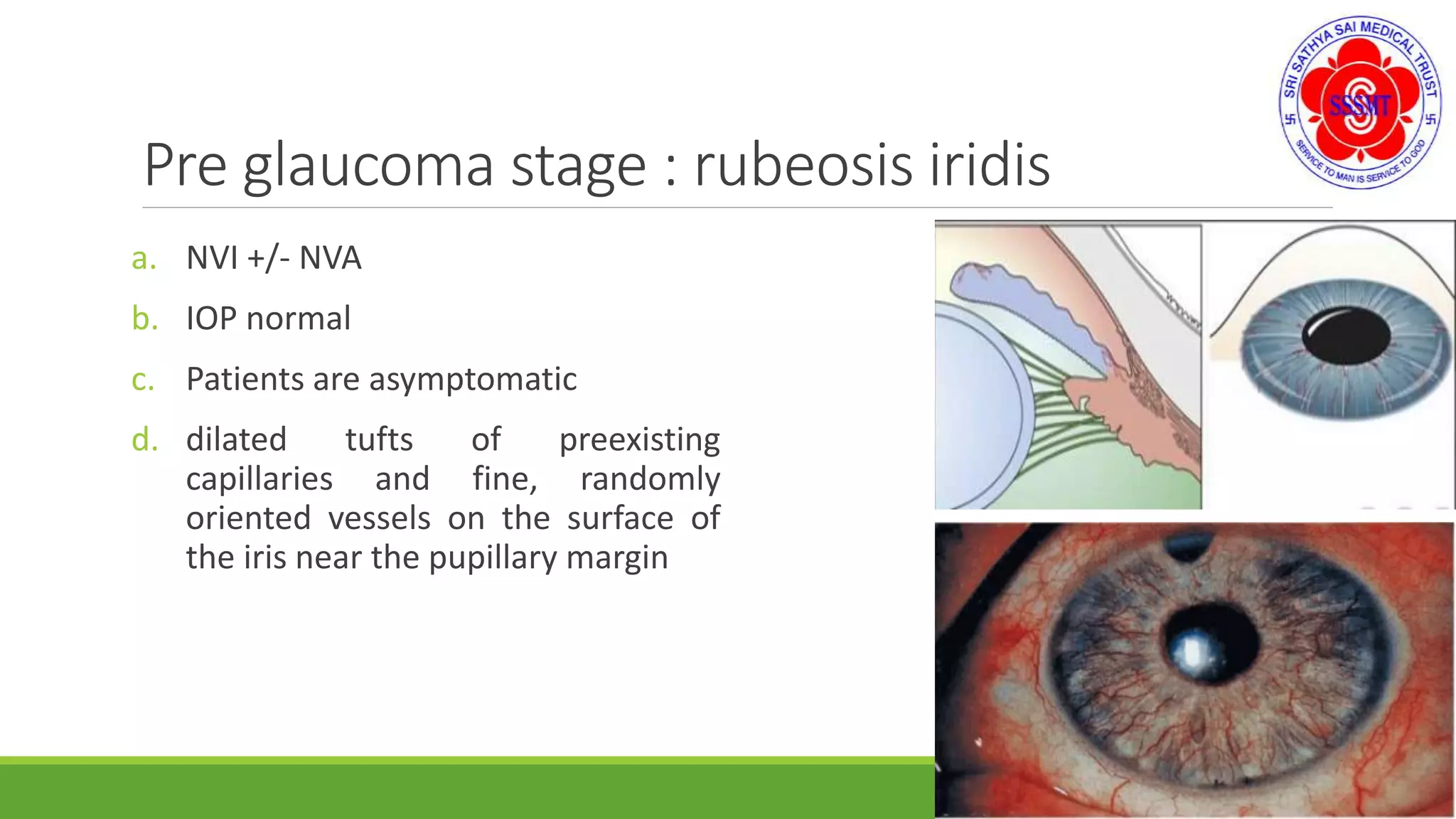 neovascular glaucoma | PPTX