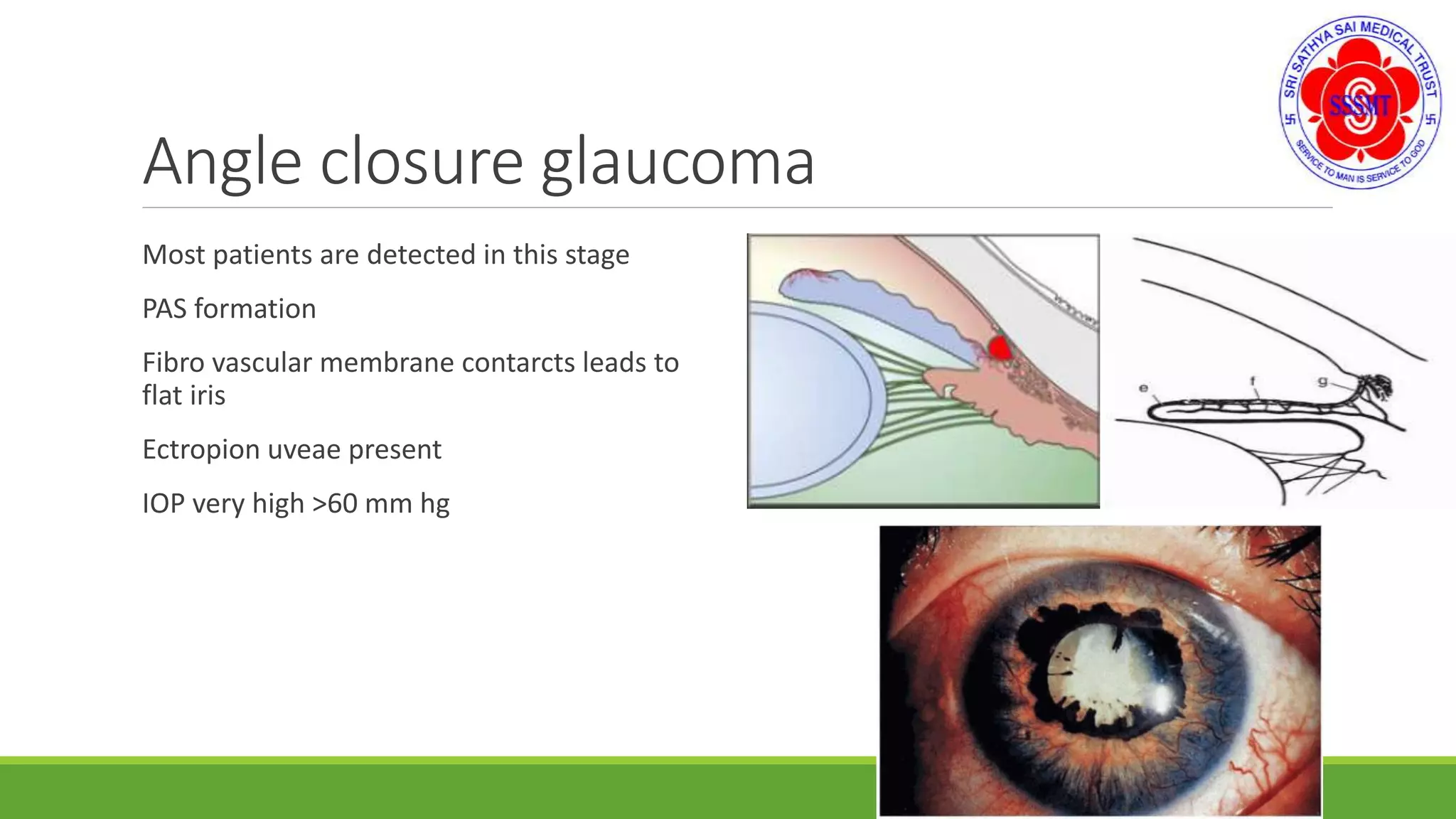 neovascular glaucoma | PPTX