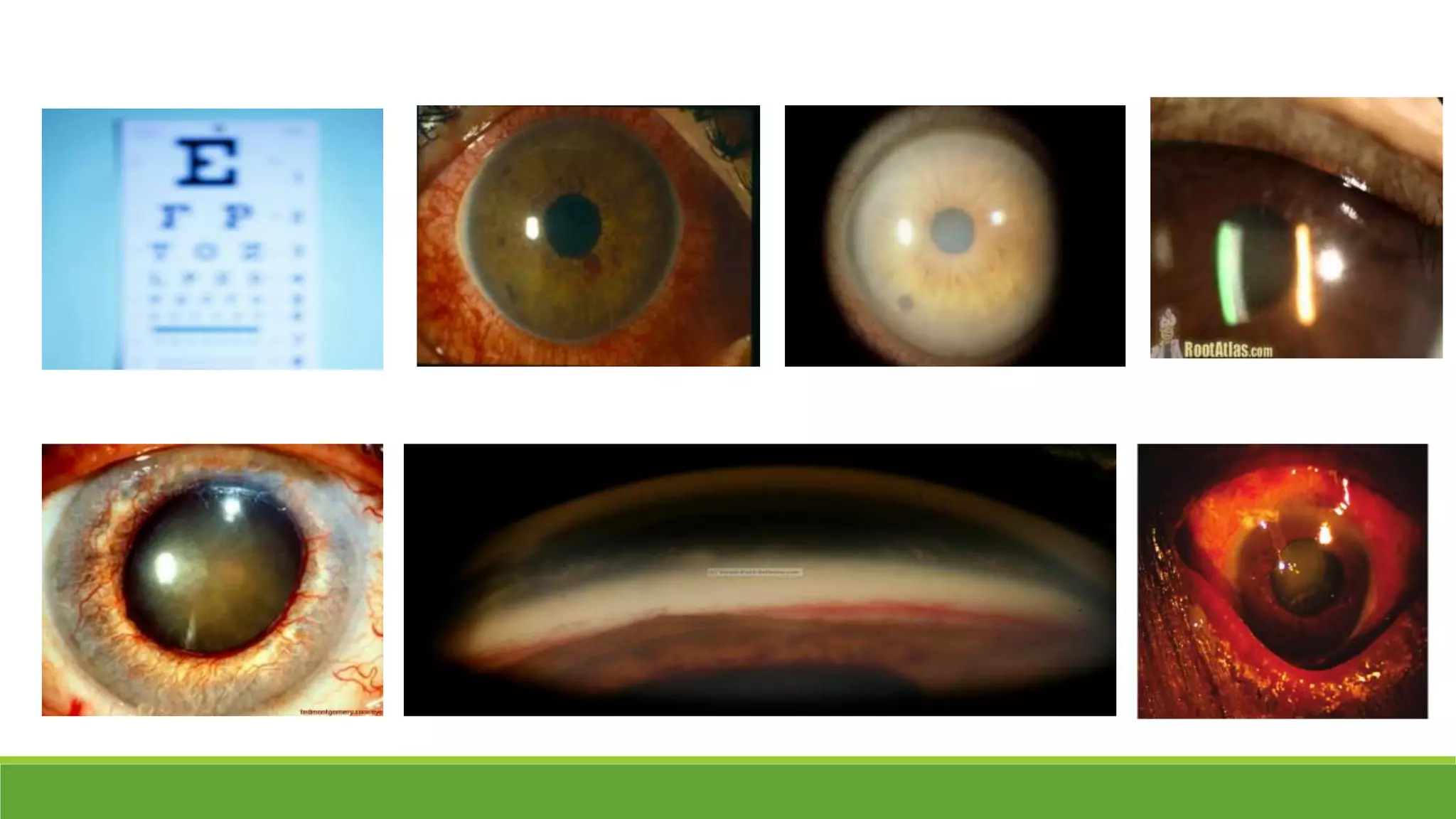 neovascular glaucoma | PPTX