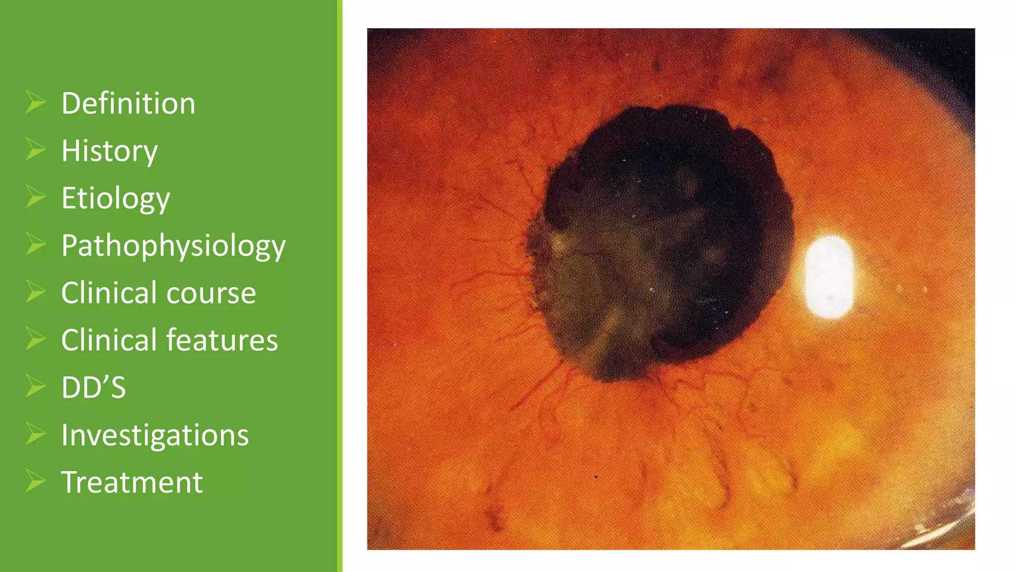 neovascular glaucoma | PPTX