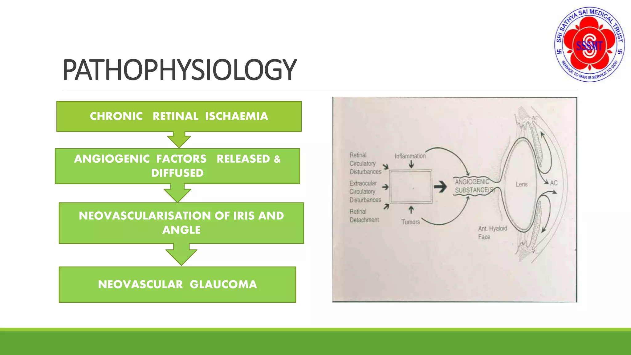 neovascular glaucoma | PPTX
