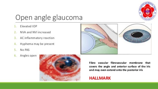 neovascular glaucoma