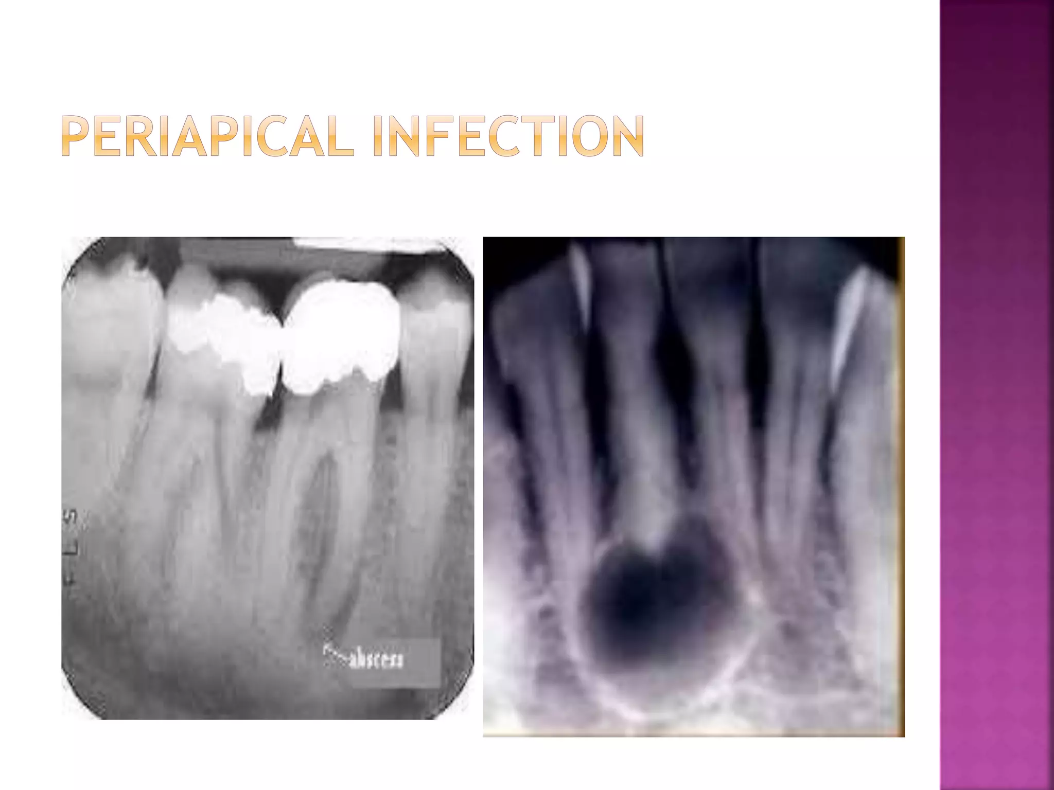 dental caries index | PPTX