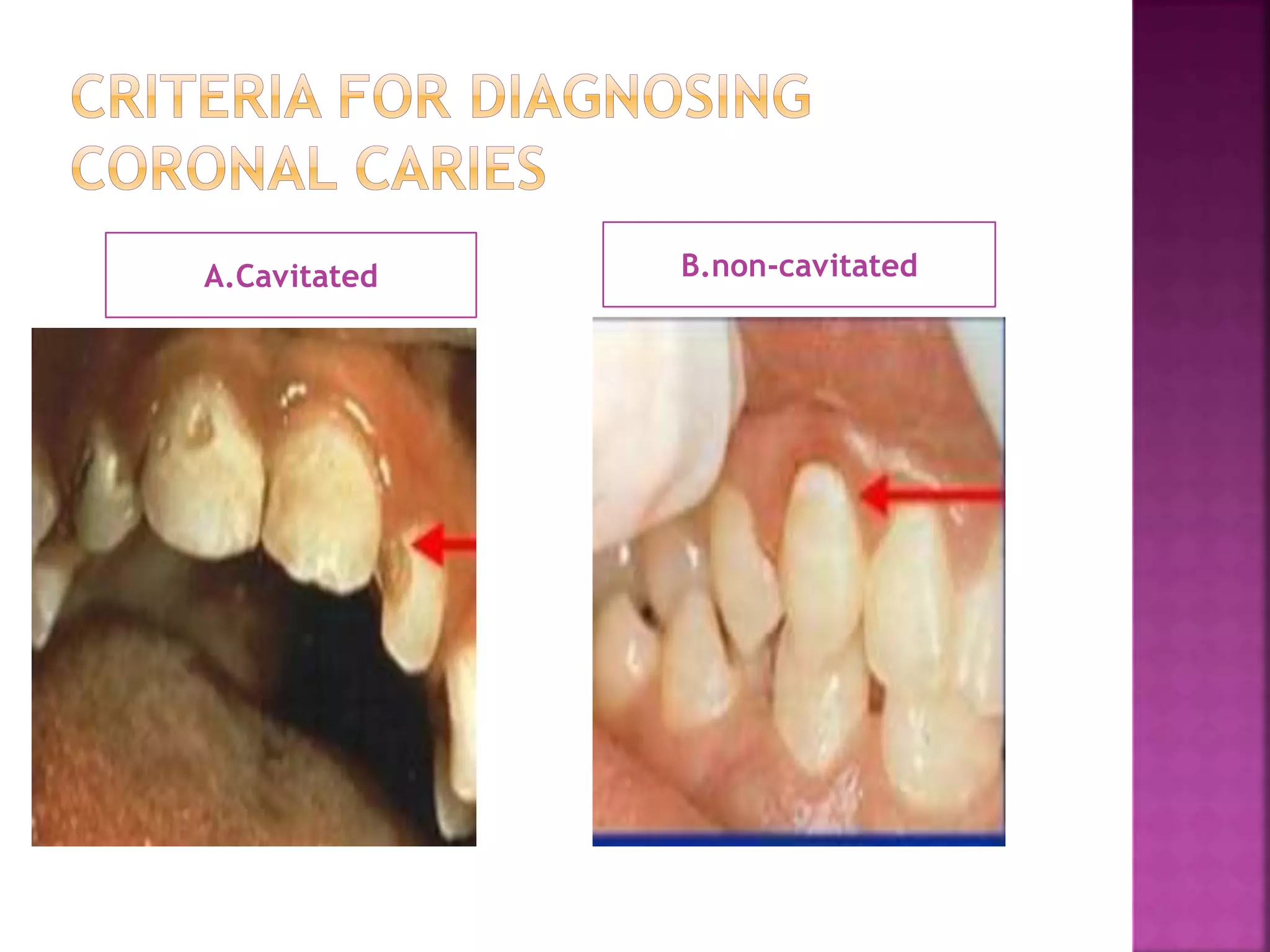 dental caries index | PPTX