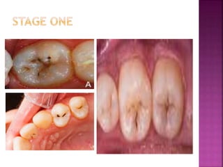 dental caries index | PPTX