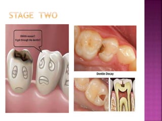 dental caries index | PPTX