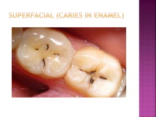 dental caries index | PPTX