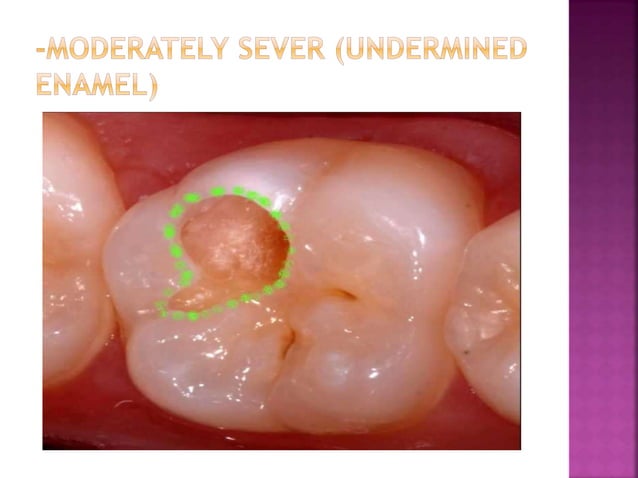 dental caries index | PPTX