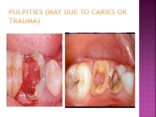 dental caries index | PPTX