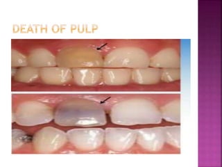 dental caries index | PPTX