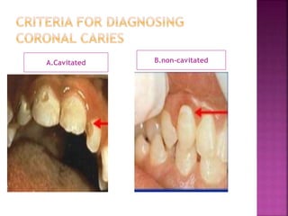 dental caries index | PPTX