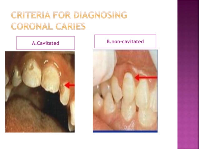 dental caries index | PPT
