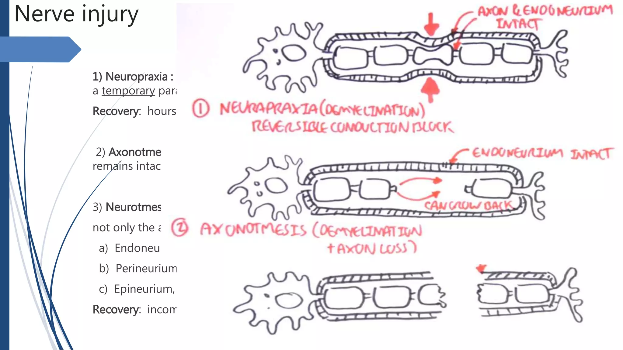 Management Of Lingual Nerve injury | PPTX