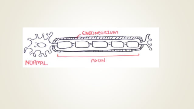 Management Of Lingual Nerve injury | PPTX