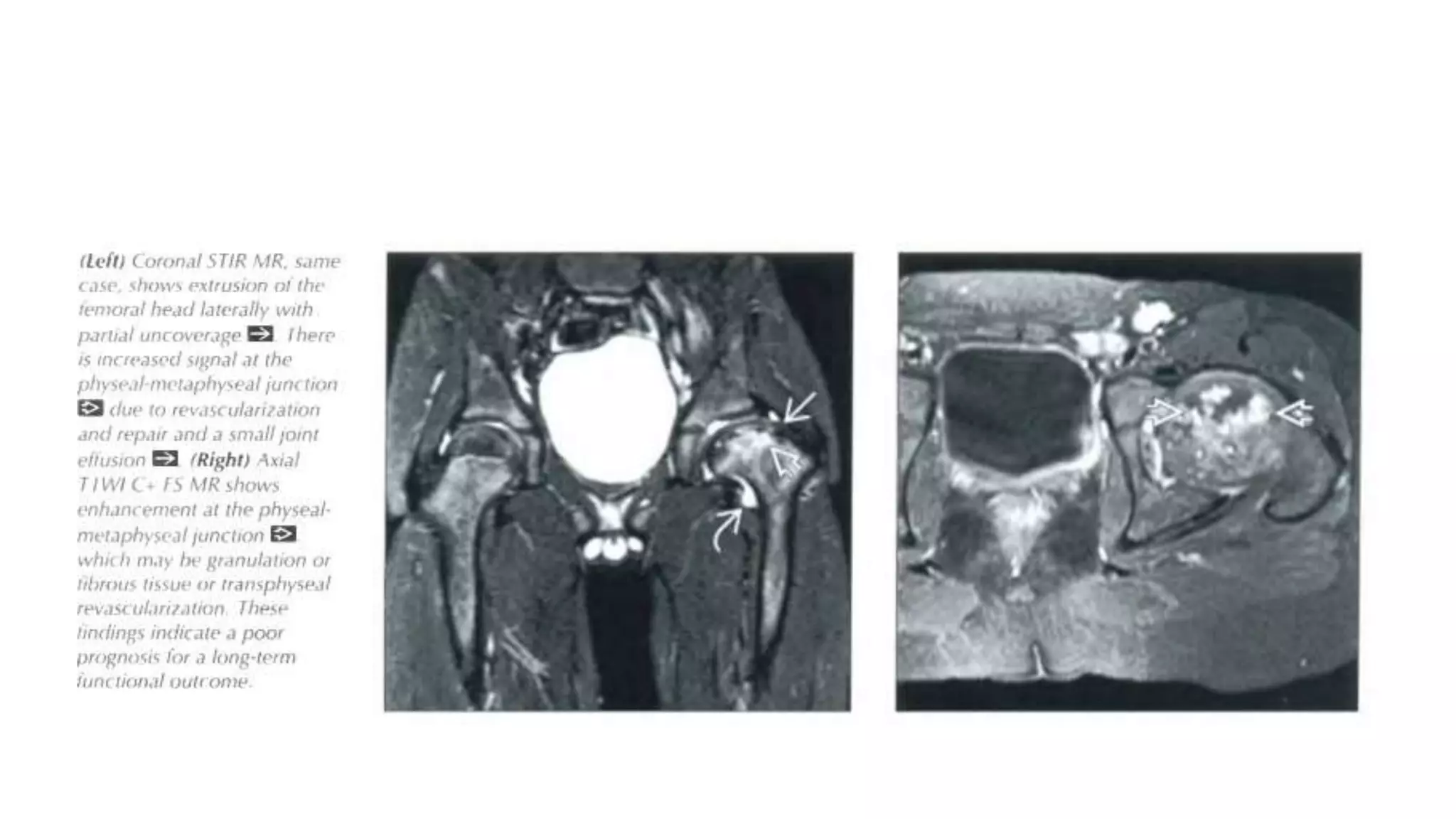 Caffey Disease ,AVN | PPTX