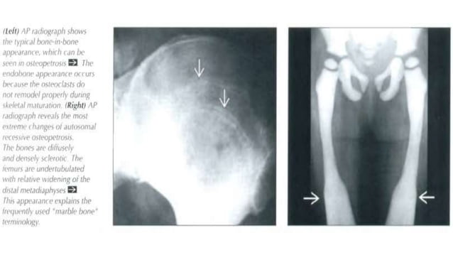 Caffey Disease ,AVN | PPT