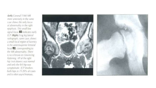Caffey Disease ,AVN | PPTX