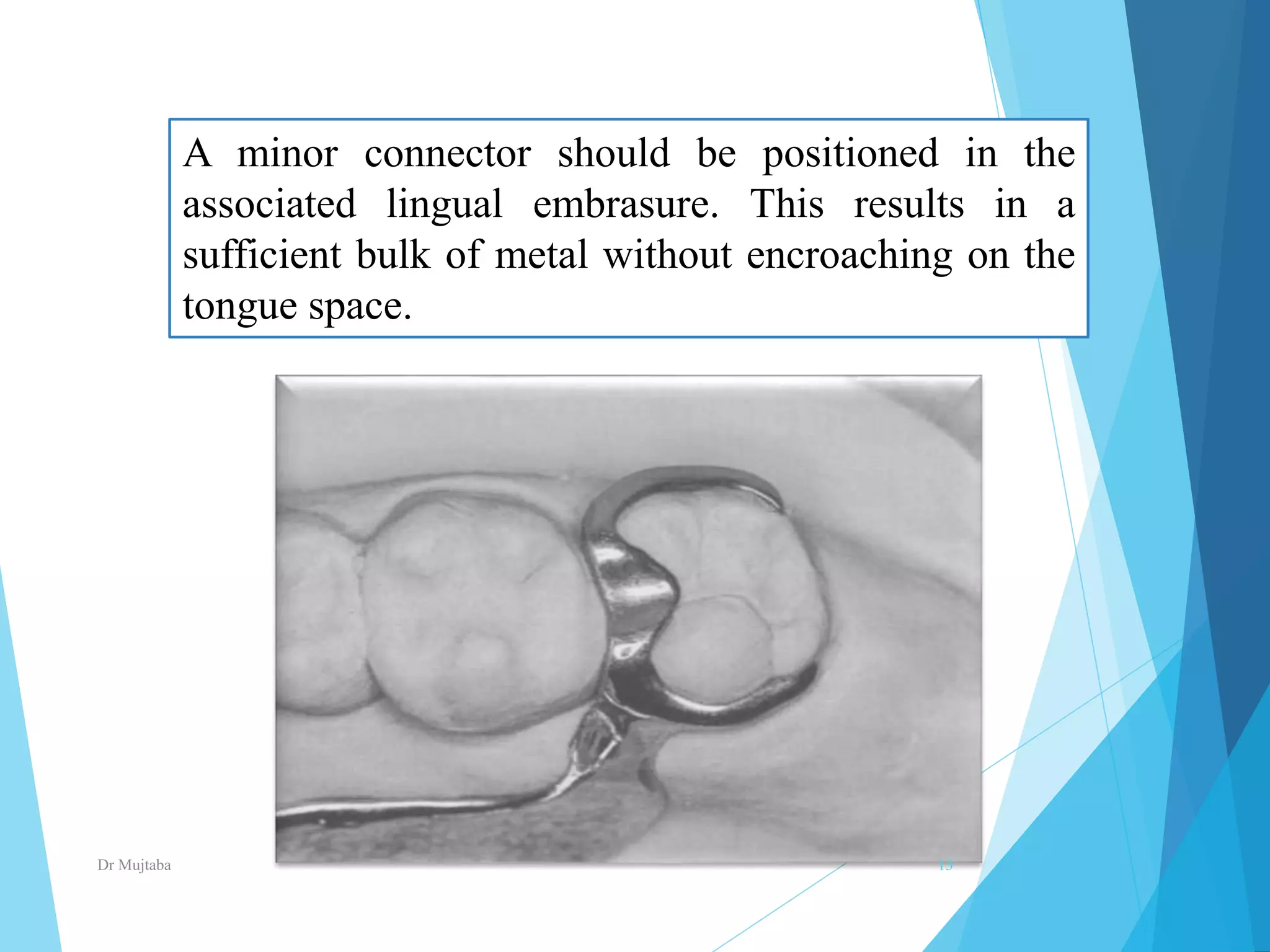 Minor connectors, rests & rests seats In prosthodontics | PPTX