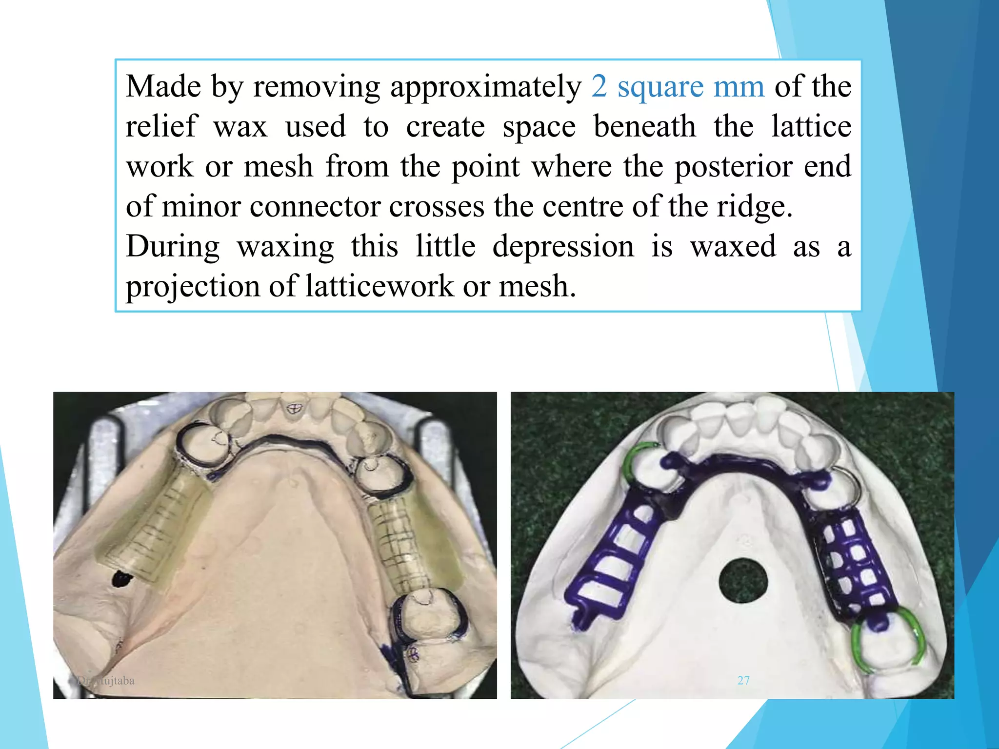 Minor connectors, rests & rests seats In prosthodontics | PPTX