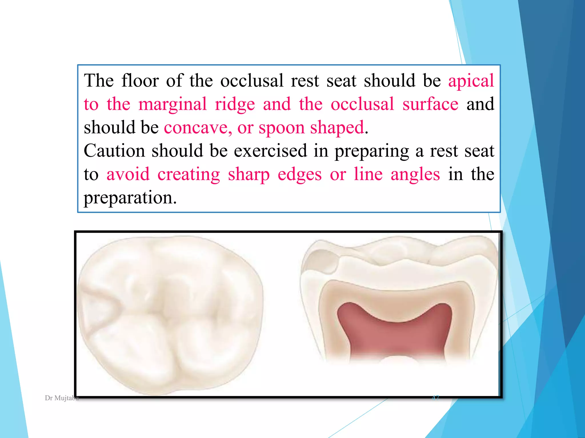 Minor connectors, rests & rests seats In prosthodontics | PPTX