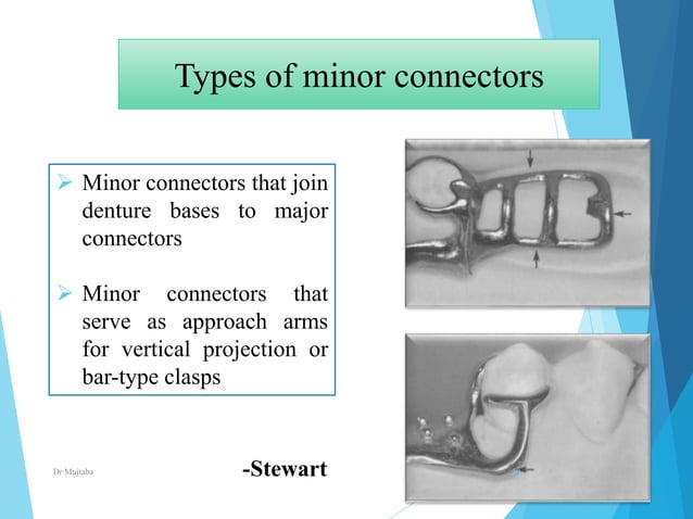 Minor connectors, rests & rests seats In prosthodontics | PPTX | Dental ...