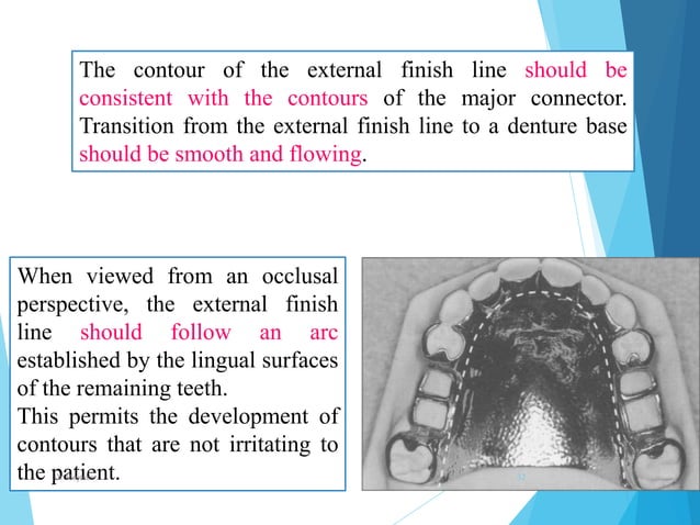 Minor connectors, rests & rests seats In prosthodontics | PPTX | Dental ...