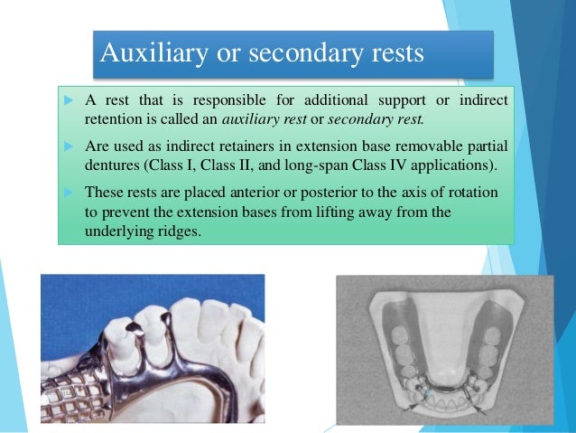 Minor connectors, rests & rests seats In prosthodontics