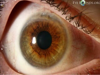 Systemic drugs affecting cornea | PPT