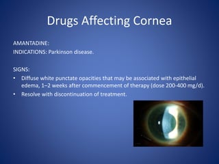 Chrysiasis Cornea