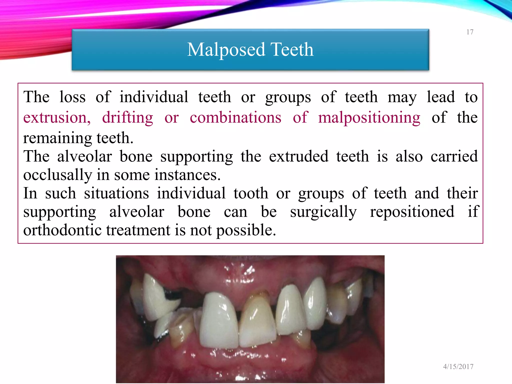 Mouth preparation for Removable dental prosthesis | PPTX