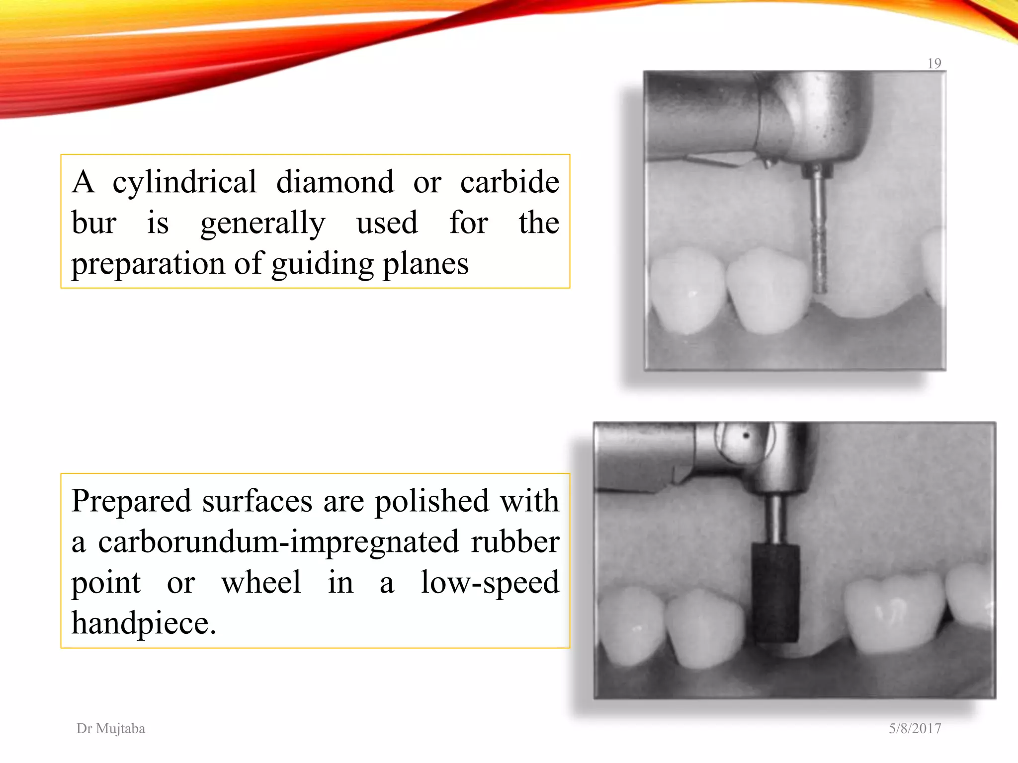 Mouth preparation for Removable dental prosthesis | PPTX