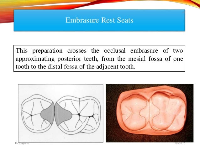 Mouth preparation for Removable dental prosthesis