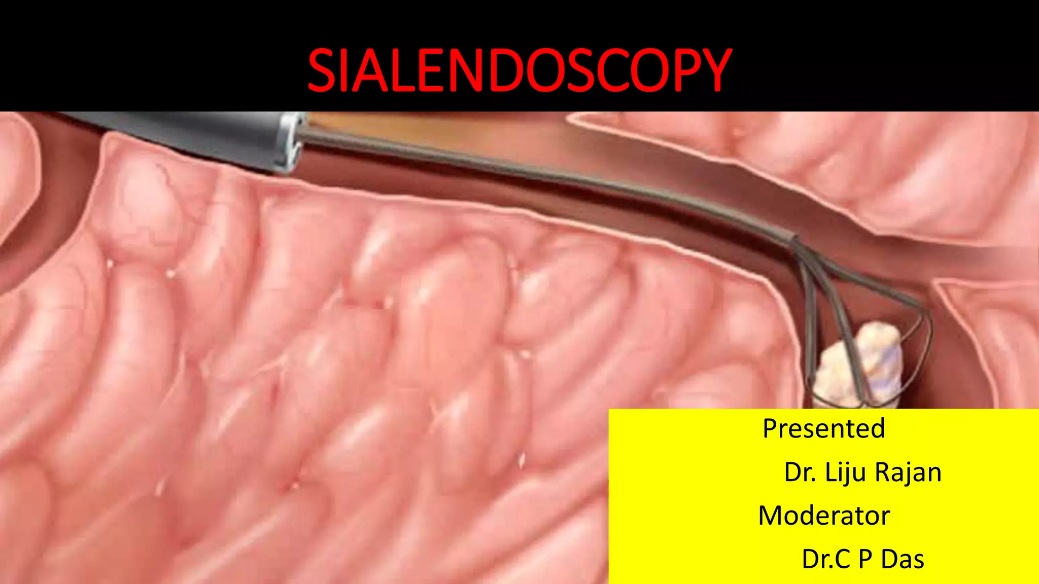 Sialendoscopy | PPTX