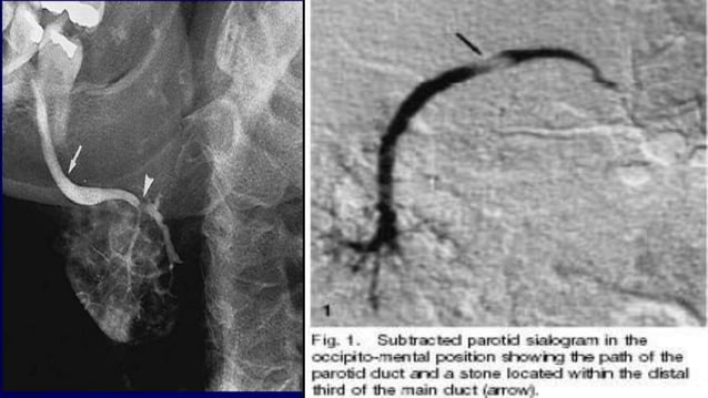 Sialendoscopy | PPTX | Ear, Nose and Throat Conditions | Diseases and ...