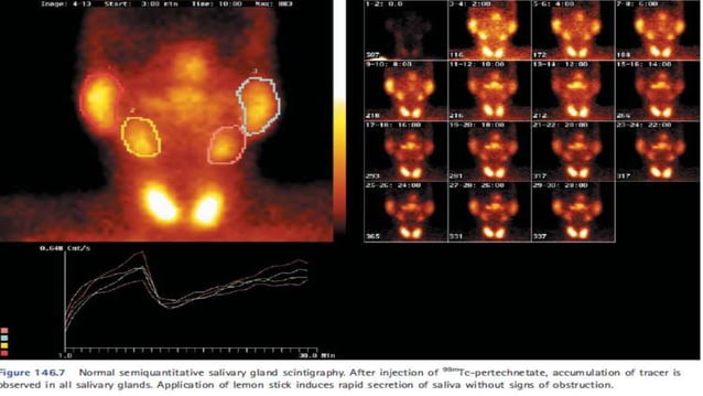 Sialendoscopy | PPTX | Ear, Nose and Throat Conditions | Diseases and ...