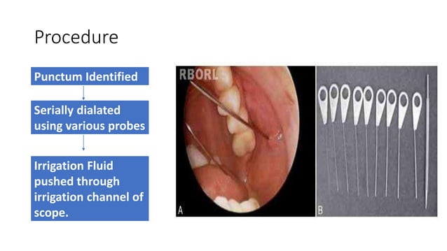 Sialendoscopy | PPTX | Ear, Nose and Throat Conditions | Diseases and ...