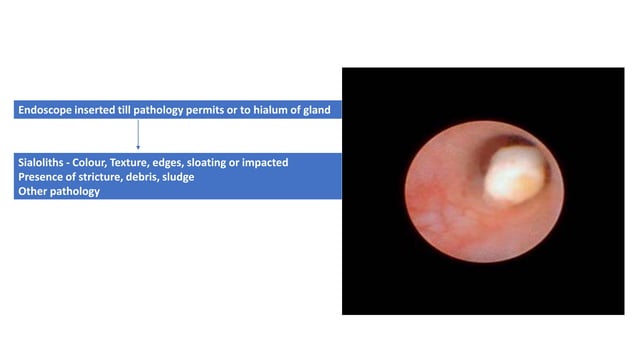 Sialendoscopy | PPTX | Ear, Nose and Throat Conditions | Diseases and ...