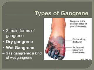 Line Of Demarcation Gangrene